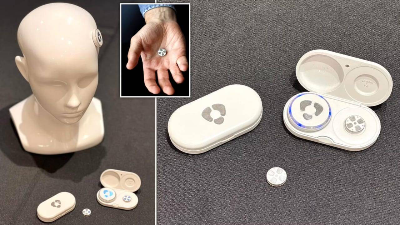 Brain implant that cures depression is undergoing test trial