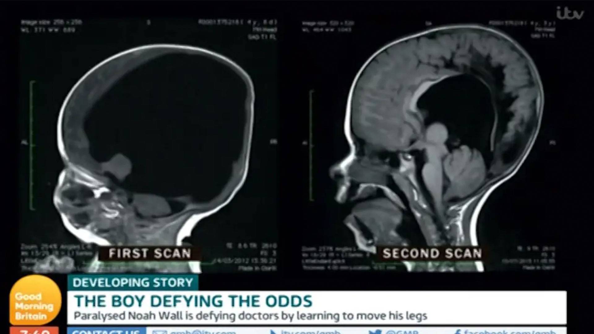Boy born without a brain defies odds and grows it back - KAYA 959