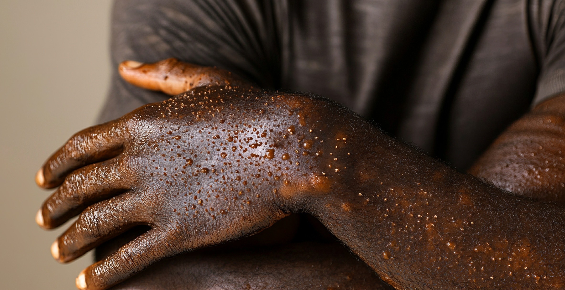 SA launches Mpox vaccination drive as confirmed cases rise